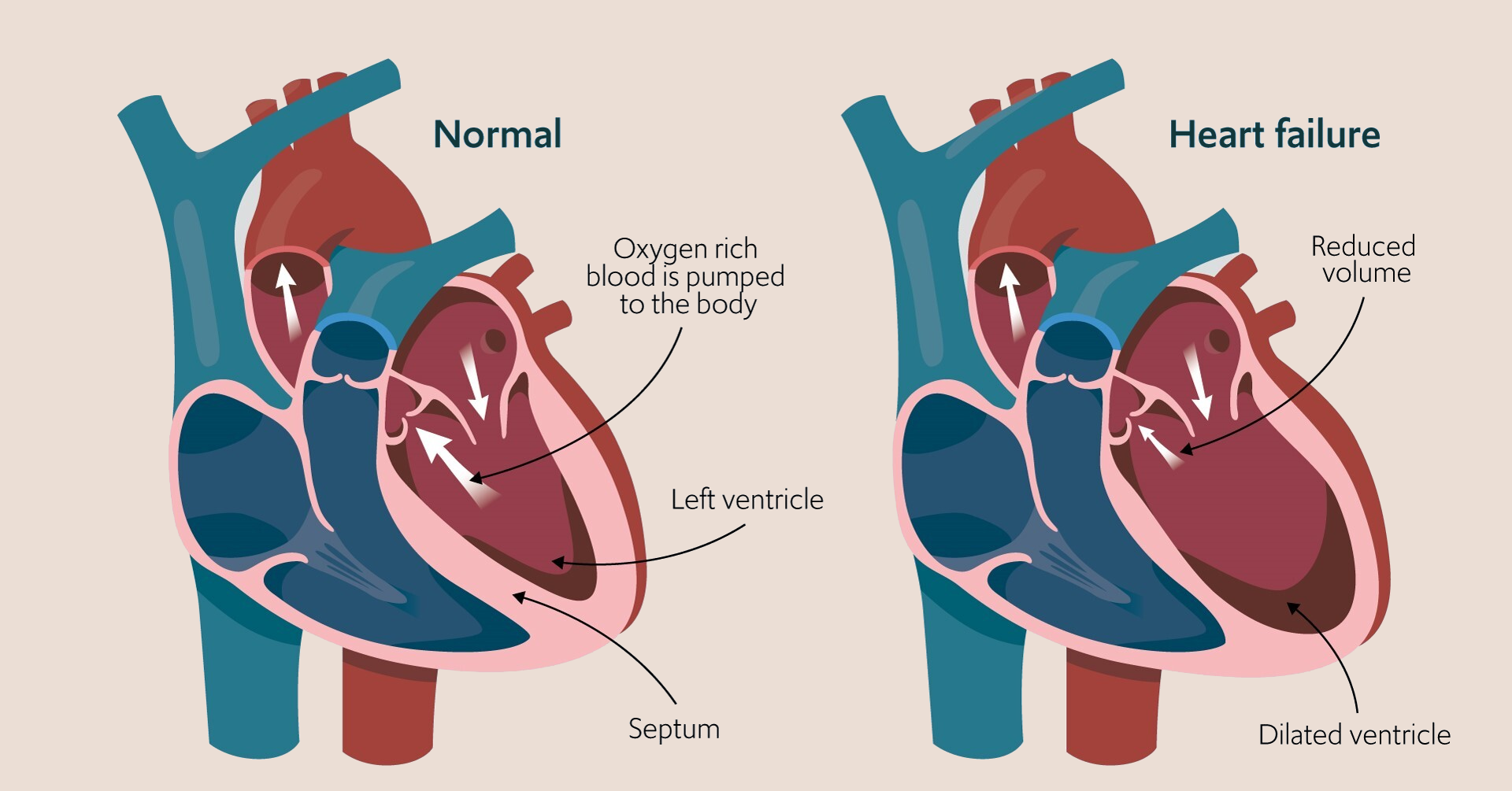 Congestive Heart Failure Congestive Heart Failure