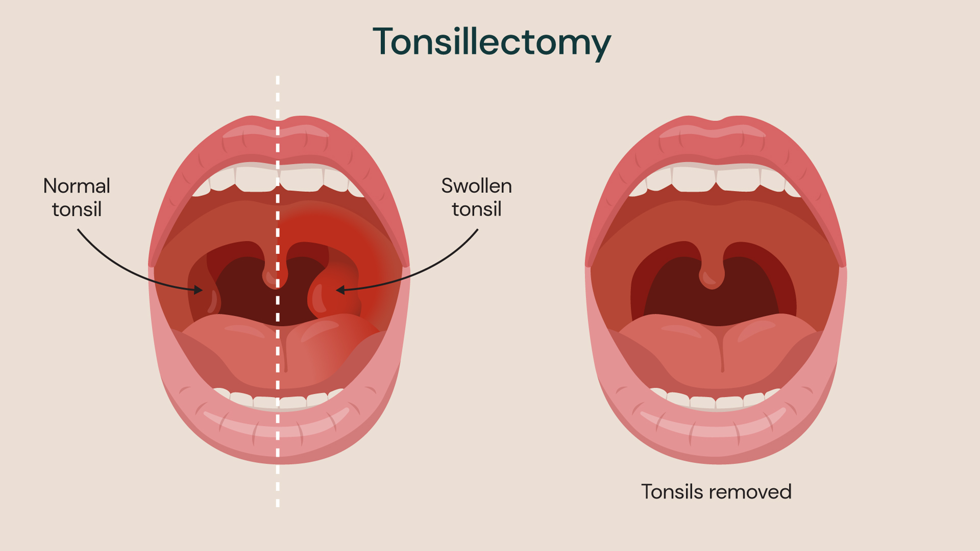 Infection After Tonsillectomy Tonsillitis Symptoms Pictures Causes Infection After Tonsillectomy Tonsillitis Symptoms Pictures Causes